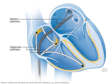 cardiac ablation mayo clinic