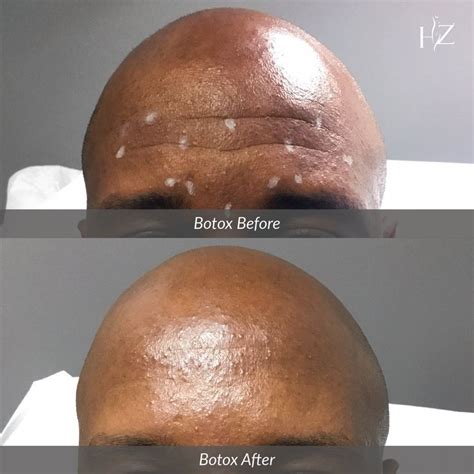 Its 2019 Of Course Men Are Getting Botox Too Our Patient Targeted