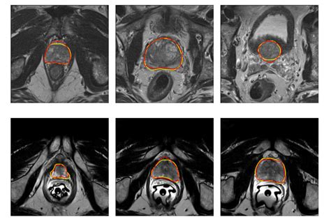 Fast Reliable Approximate Automatic Image Segmentation For Prostate