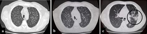 Evolution Of Chest Computed Tomography Images Multiple Bilateral