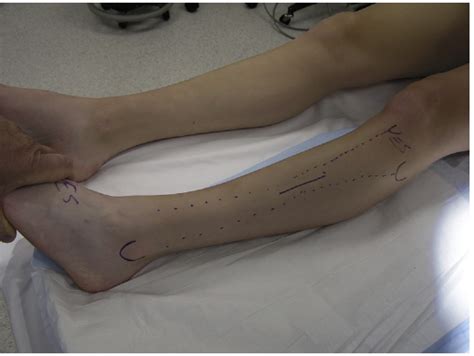 Emerging Treatment For Compartment Syndrome Sports Medicine Review