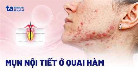 Mụn Ở Quai Hàm Là Bị Gì Nguyên Nhân Và Cách Điều Trị Hiệu Quả
