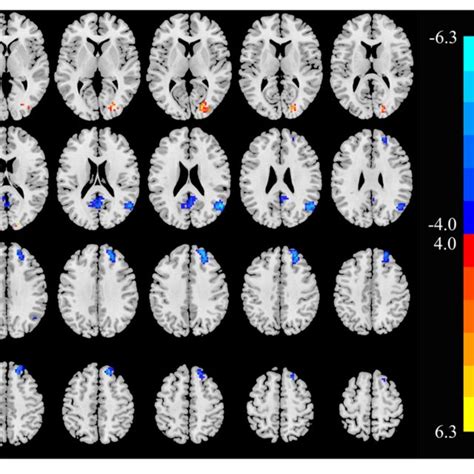 Functional Connectivity Fc Differences In The Right Angular Gyrus