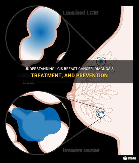 Understanding Lcis Breast Cancer Diagnosis Treatment And Prevention
