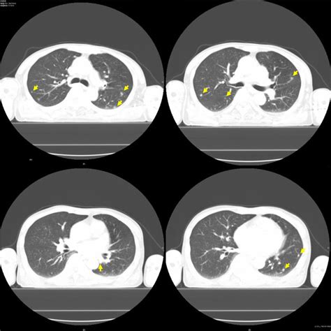 Computed Tomography Showed Multiple Nodules In Bilateral Lungs Yellow