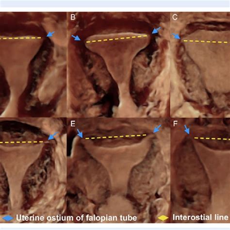 Class U3 Or Bicorporeal Uterus By The Eshre Esge System External Cleft