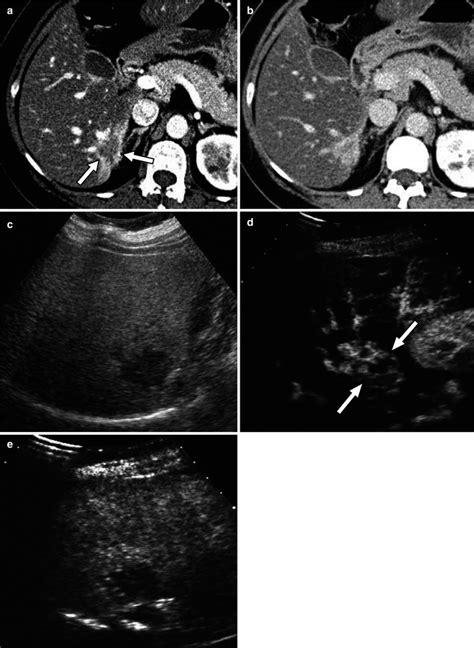 Benign Liver Tumors Radiology Key