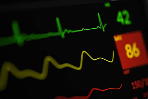 Learn The New Atrial Fibrillation Guidelines Daily Remedy