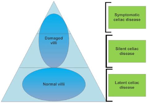 Understanding Celiac Disease From Genetics To The Future Diagnostic