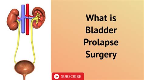What Is Bladder Prolapse Surgery Youtube