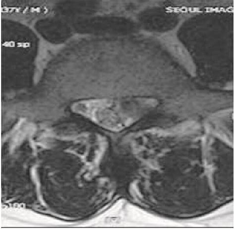 Case Of Early Recurrence After Peld Preoperative Mri Shows L4 5 Disc