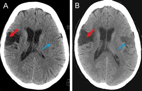 Ischemic Stroke Concise Medical Knowledge