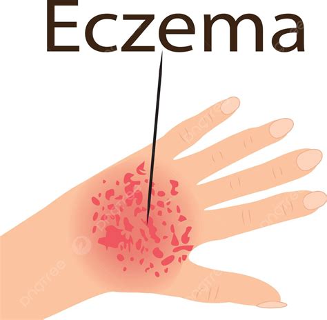 Eczema Affected A Hand Dermatology Skin Disease Dermatologist Allergy