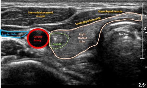 Ai Boosts Ultrasound For Thyroid Cancer Screening