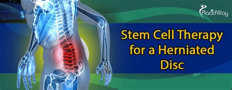 Stem Cell Therapy For A Herniated Disc