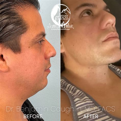 Combination Of Morpheus8 Jawline Sculpting Buccal Fat Removal Chin