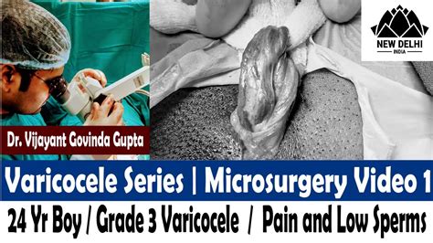 Varicocelectomy Microsurgery