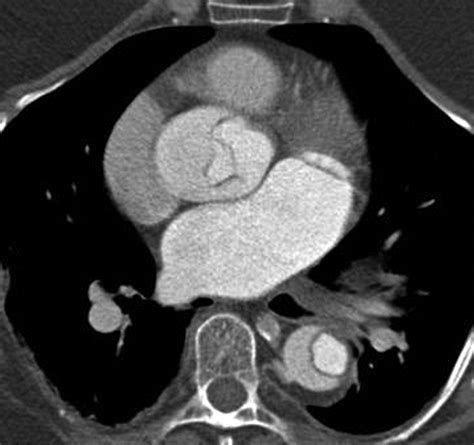 Multidetector Ct Of Aortic Dissection A Pictorial Review Radiographics