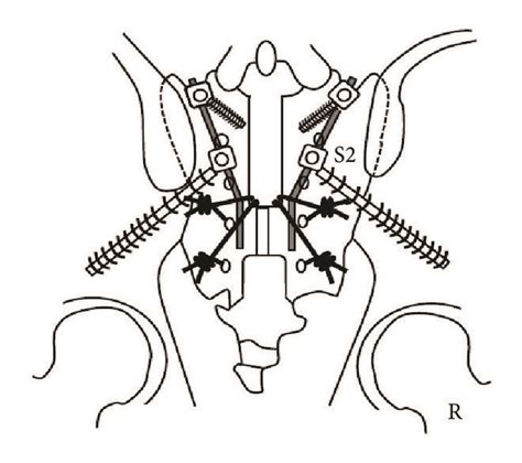 Postoperative Three Dimensional Computed Tomography Ct And Schema