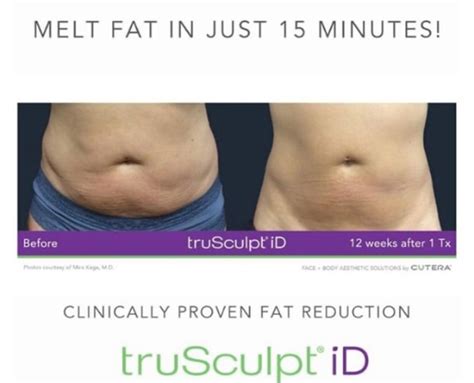 Trusculpt Id Brandywine Med Spa