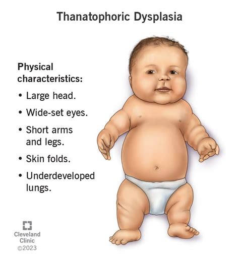 دیسپلازی تاناتوفوریک Thanatophoric Dysplasia چیست ؟ بیومایند