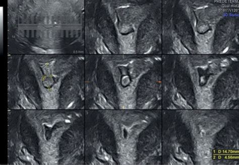 Chapter 4 Sonographic Assessment Of Uterine Fibroids And Adenomyosis