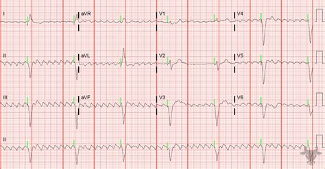 Paced Rhythms Ecg Stampede