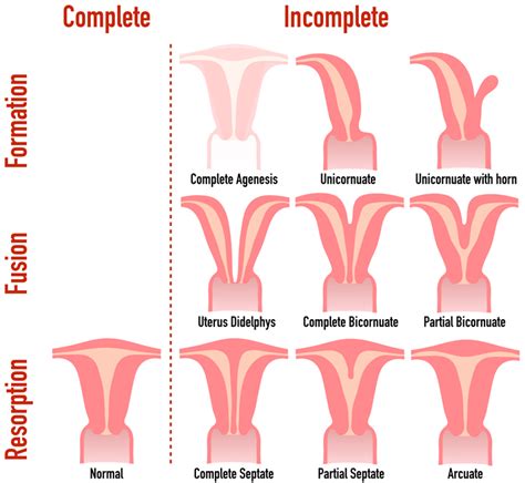 What Is The Relationship Between Uterine Abnormalities And Infertility