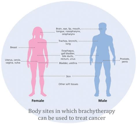 Brachytherapy Asian Alliance Radiation And Oncology Aaro