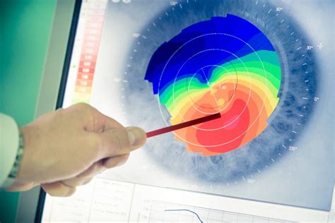 Baltimores Keratoconus Specialists Columbia Md Patch