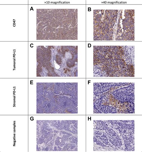 Clinical And Prognostic Implications Of Cd47 And Pd L1 Expression In