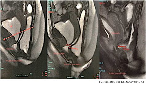 Pelvic Floor Descent Radiology