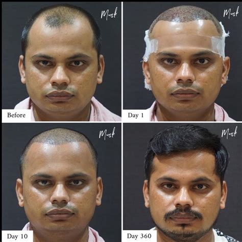 Share 75 Hair Transplant After 4 Months Super Hot In Eteachers