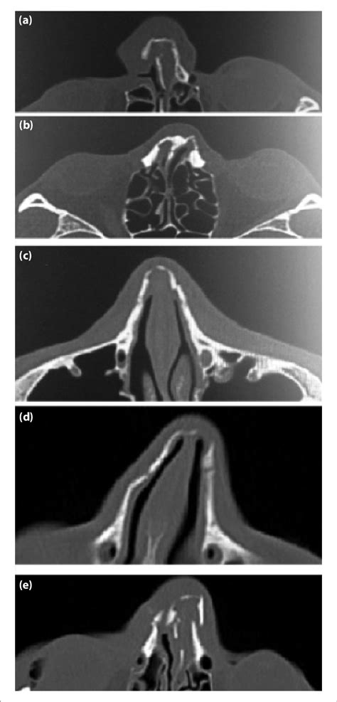 Comminuted Nasal Bone Fracture