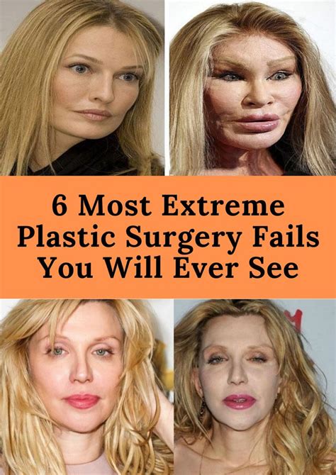 6 Most Extreme Plastic Surgery Fails You Will Ever See Extreme