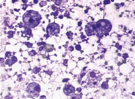 Centrifuged Bronchoalveolar Lavage Hematoxylin And Eosin Staining