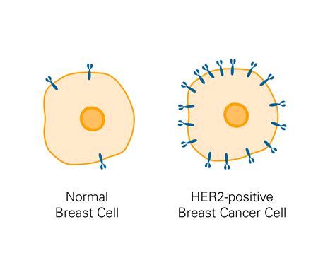 What Is Her2 Positive Breast Cancer Dana Farber Cancer Institute