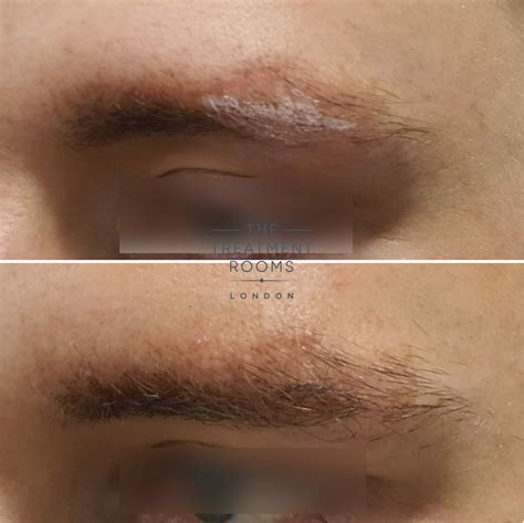 How Does An Eyebrow Hair Transplant Work Contact Us