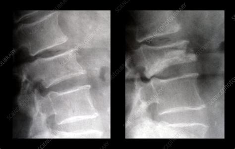 Lumbar Compression Fracture Stock Image M330 1636 Science Photo