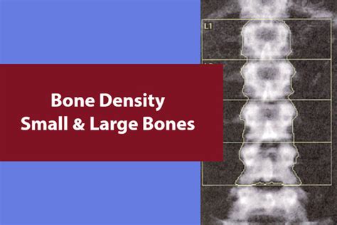 Bone Density And Fracture Risk For Various Bone Sizes Dr Lani Simpson