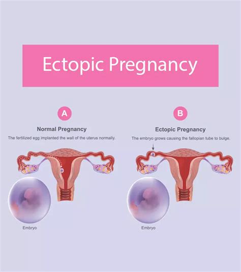 Ectopic Pregnancy Causes Symptoms Treatment And Risks