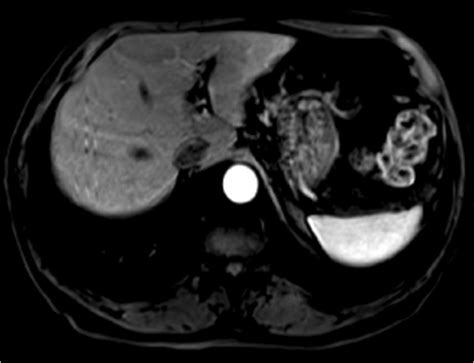 Axial Three Dimensional Arterial Phase Gradient Echo Gre T1 Weighted