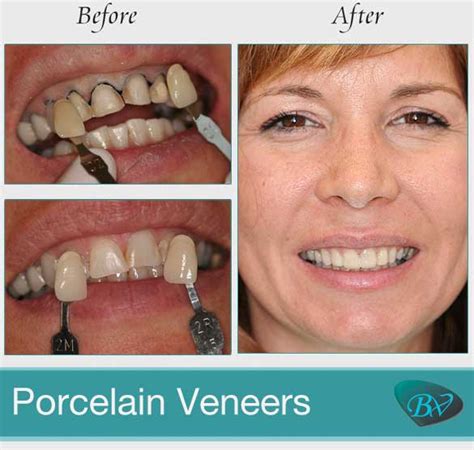 Step By Step Guide To Porcelain Veneer Procedure West Hollywood