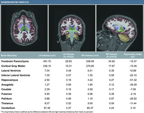 mesial temporal sclerosis accuracy of neuroquant versus