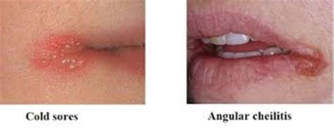 Cold Sores Vs Angular Cheilitis