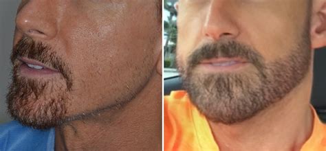 Beard Transplant Photos Miami Fl Patient 2776