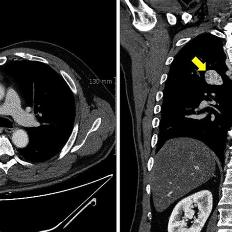 Contrast‐enhanced Chest Computed Tomography Shows About A 3 5 Cm Sized