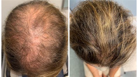 Unveiling The Power Of Dht Blockers Combatting Hair Loss With