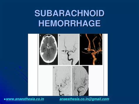 Ppt Subarachnoid Hemorrhage Powerpoint Presentation Free Download