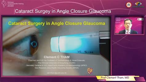 Cataract Surgery In Angle Closure Glaucoma Youtube